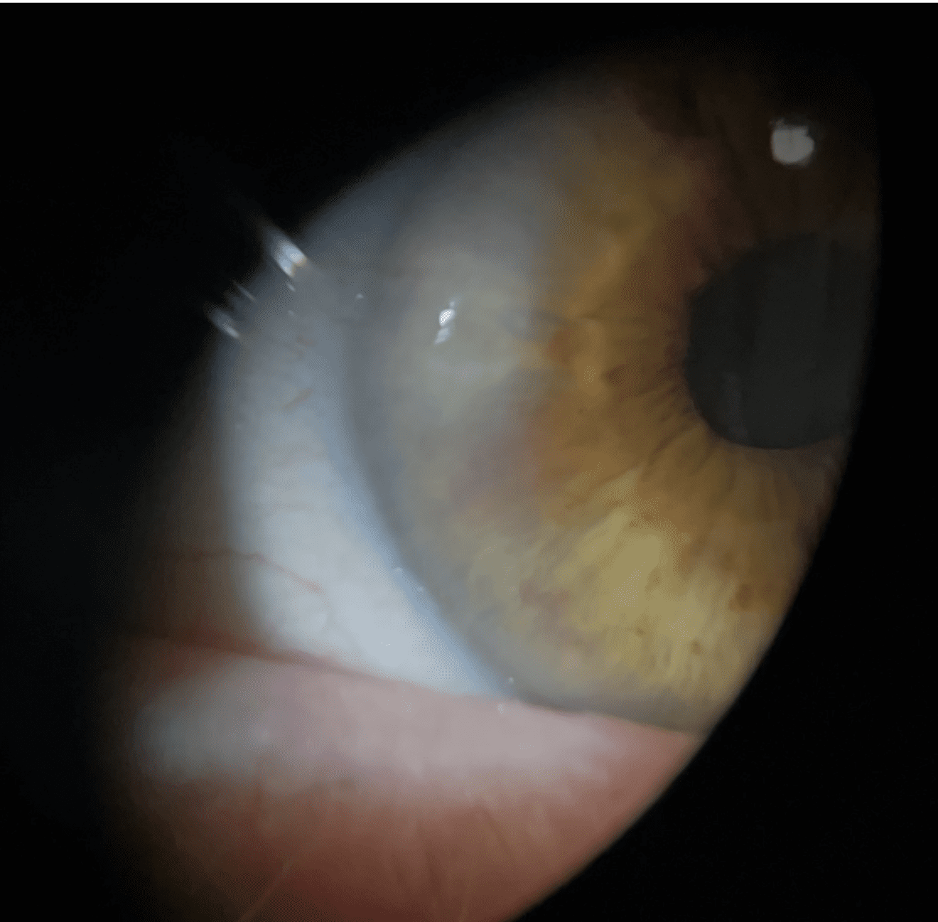 Keratoconus Patient Finds Clear Vision With Scleral Lenses